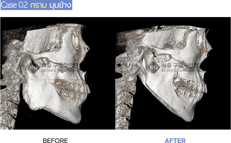 ศัลยกรรมโครงหน้า ผู้หญิง - Oral & Maxillofacial Face Bone Surgery